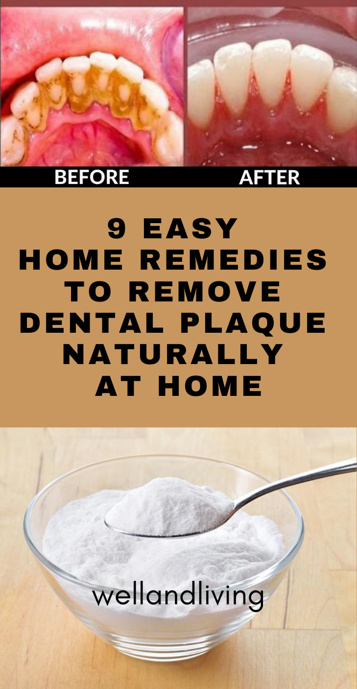 Plaque Removal At Home: 9 Easy Home Remedies to Remove Dental Plaque ...