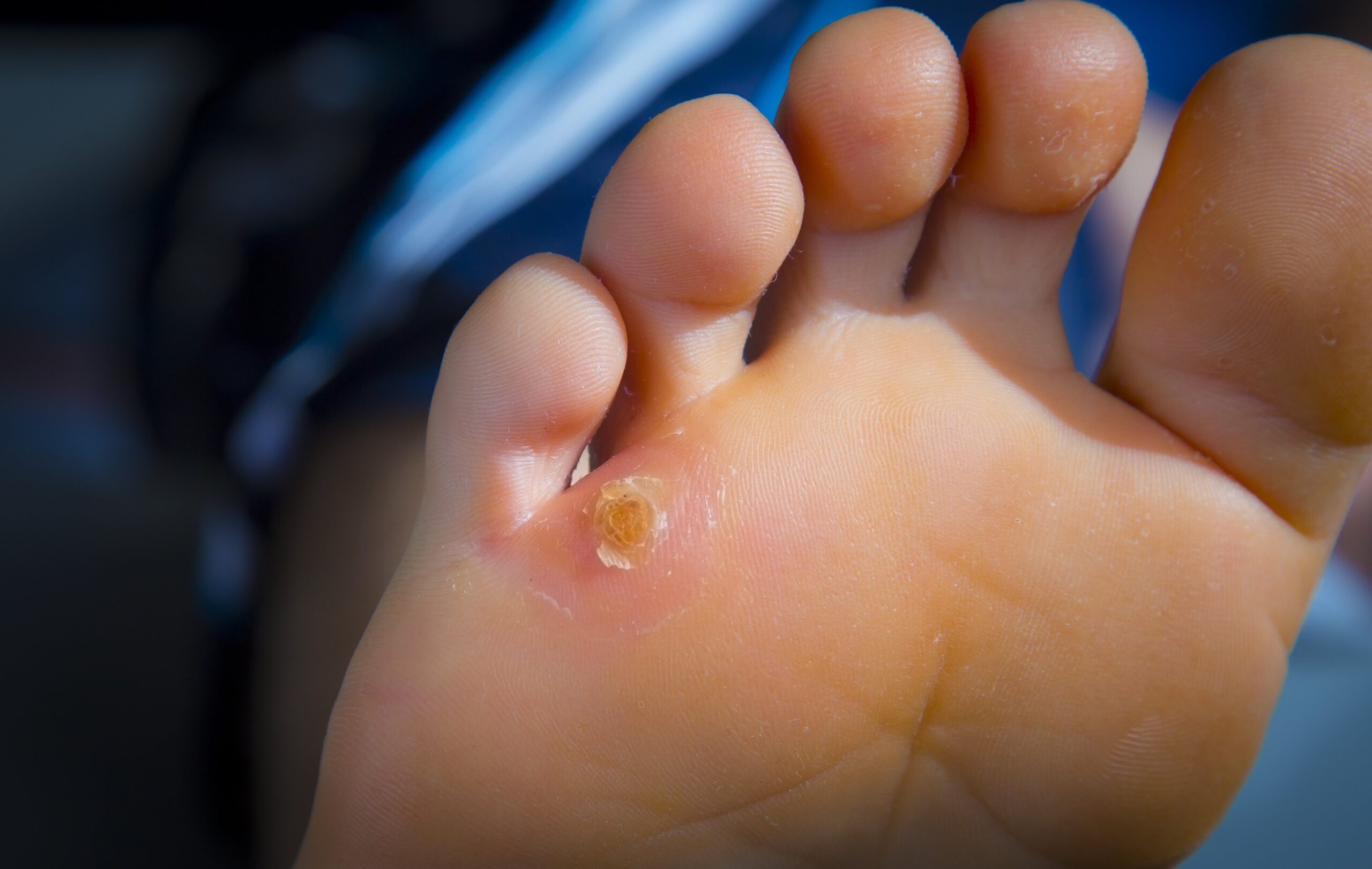 How to Get Rid Of Calluses on Your Feet: 6 Home Remedies - Saayla